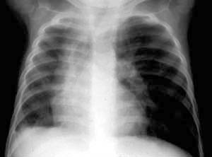 swyer james macleod sendromu - uludağ sözlük